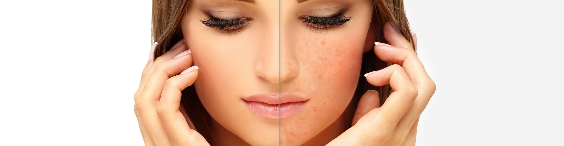 La rosacée, ou quand la peau fait sa révolution